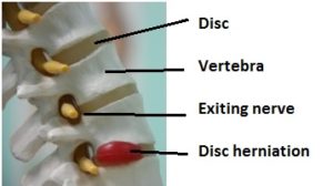 Slipped disc, herniated disc, crumbling disc, trapped nerve, sciatica ...